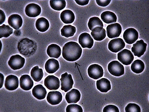 Anisocytes as seen in the Live Blood Analysis Training Course – often ...