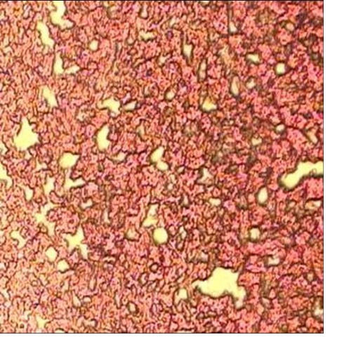 A Typical Live Blood Analysis Case