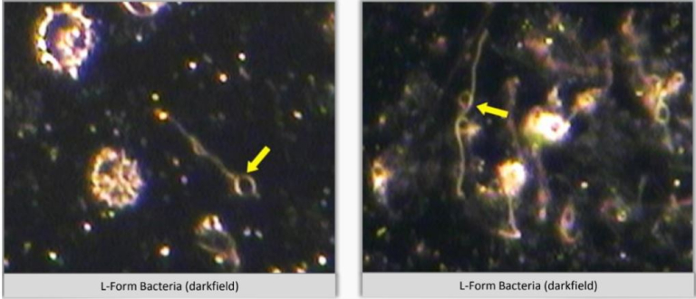 L-Form Bacteria (cell wall deficient forms) in LBA